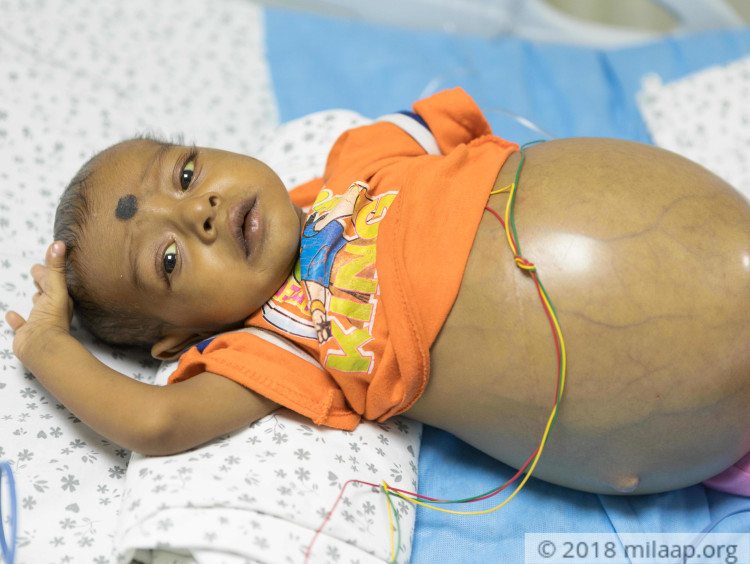 Liver Disease In Babies - Pregnancy Informations