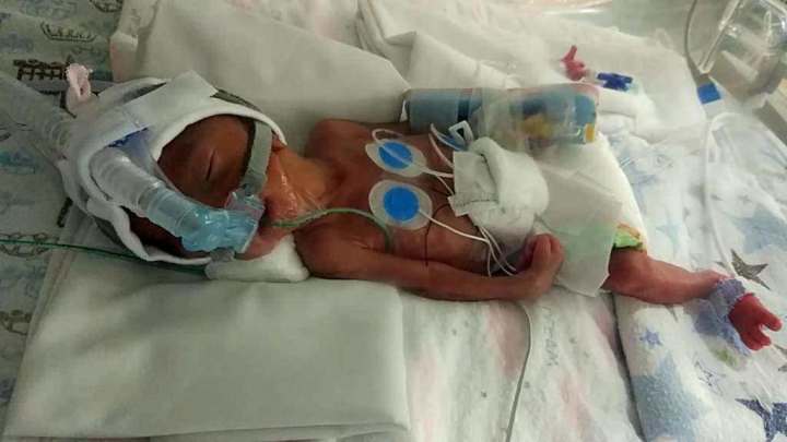 Help!! 25 weeks Premature Baby is in NICU, Family Need Help!! | Milaap
