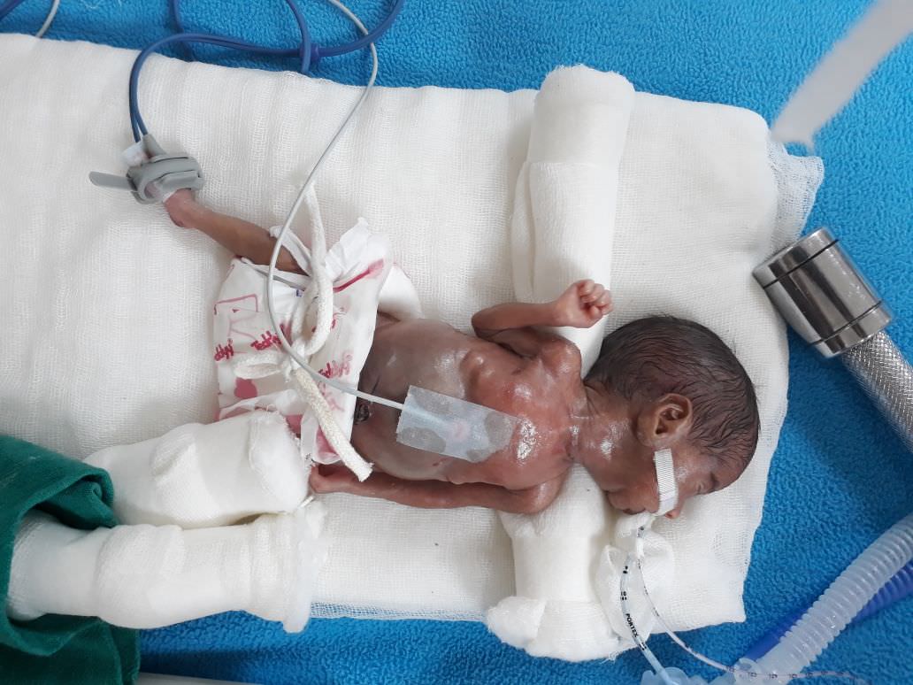 My Baby Was Born 3 Months Premature And She Is Struggling To Survive ...